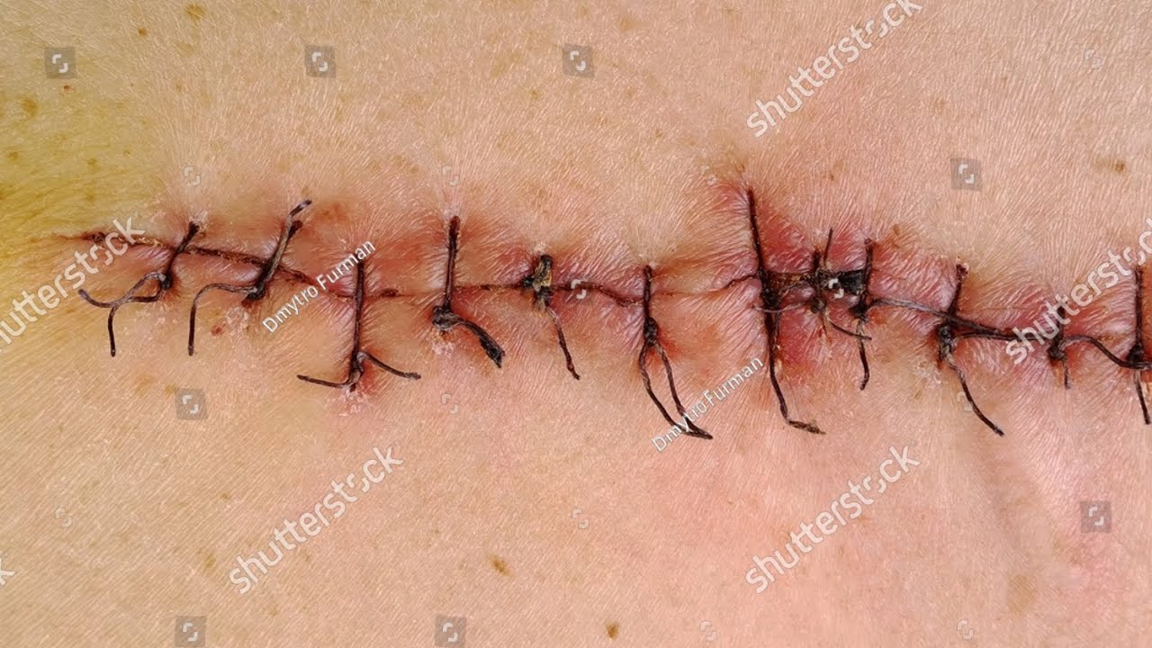 SUTURES OF OPEN WOUND (Hina Aslam medical center)(Services Hospital ...
