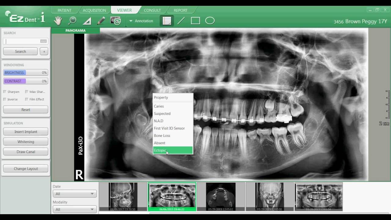 EZDent i, Chapter 03 05 Annotation Tool Bar FINAL - YouTube