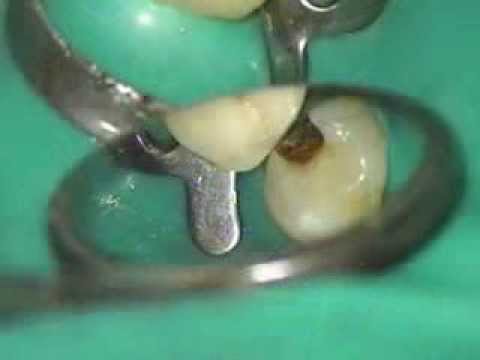 proximal box-microscopic prep,finish and restore - YouTube