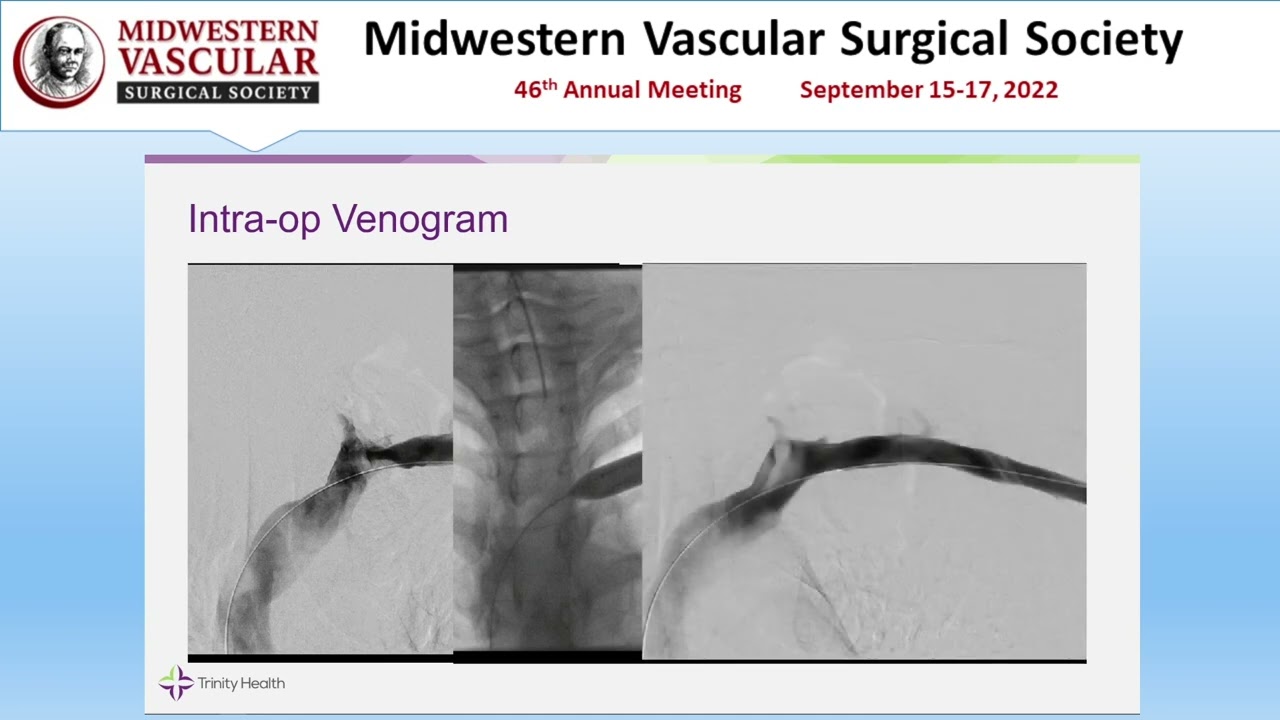 Hybrid Paraclavicular Decompression and Primary Endovascular ...