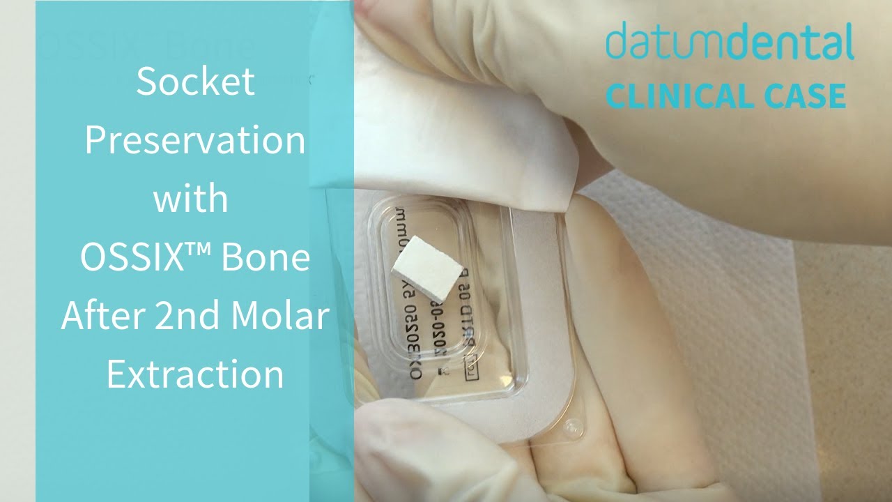 Clinical Video Case Socket Preservation with OSSIX Bone After 2nd Molar ...