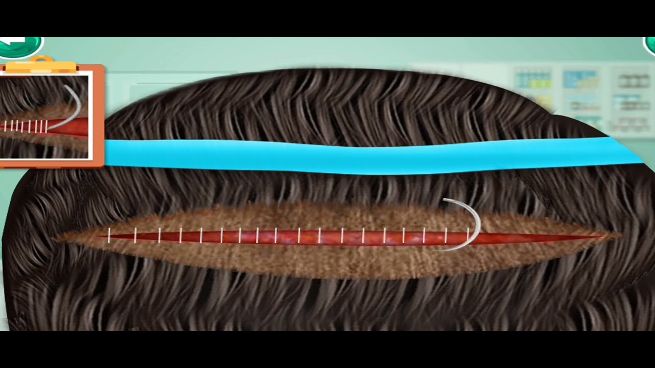 Head Hair Transplant surgery ASRM animation 2023 - YouTube