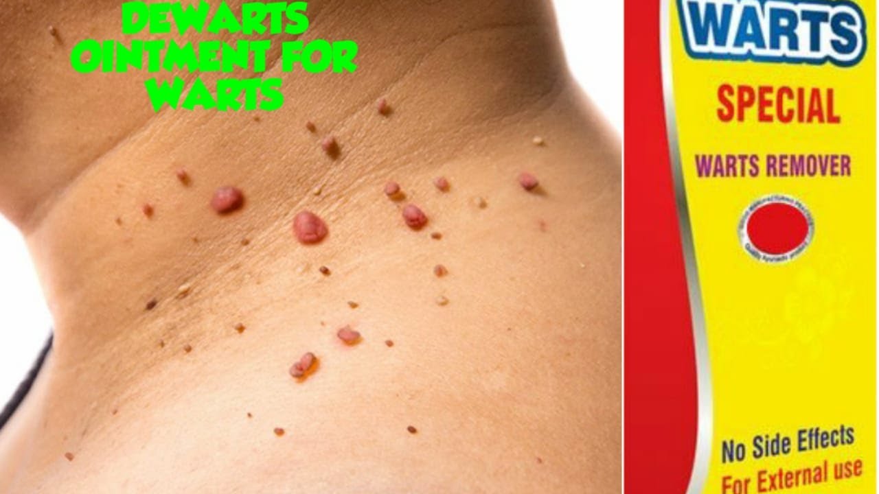 DEWARTS CREAME FOR WARTS(PULIPIRLU).... - YouTube