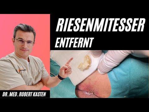 RIESENKOMEDO in der Leiste entfernt: Hautarzt kann es kaum fassen. Mitesser  #pimple giant comedone
