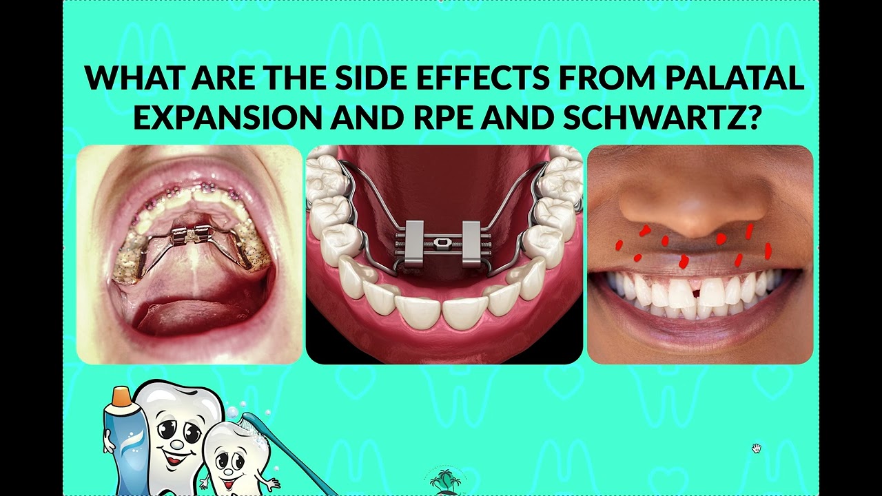 What are the Side Effects of Expansion in Schwartz and RPE? - YouTube