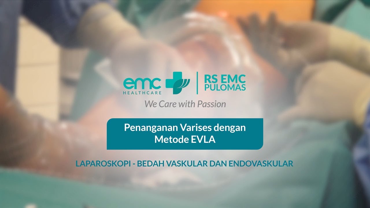 Penanganan Varises dengan Metode EVLA - EMC Pulomas - YouTube