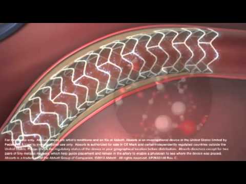 Abbott's Absorb Bioresorbable Scaffold Completes Enrollment in 3 ...