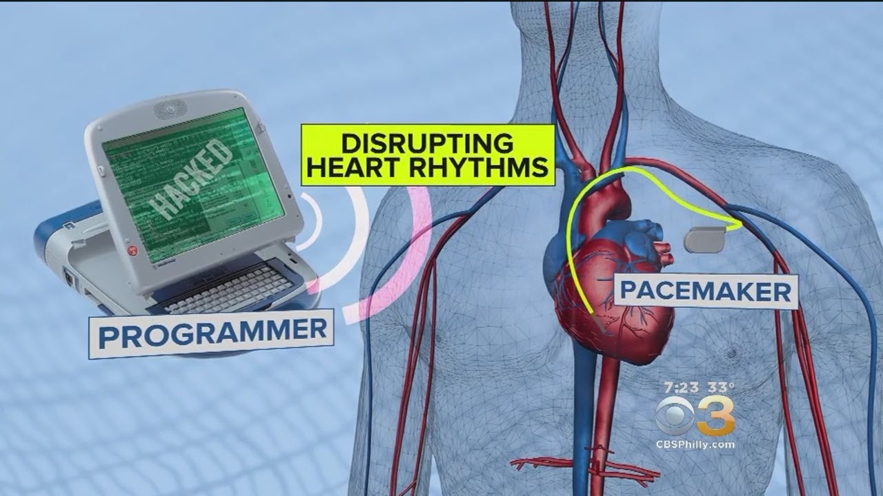 Researchers Say Implanted Medical Devices Vulnerable To Hackers - YouTube