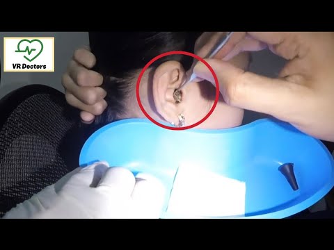 Girl Hard Ear Wax Removing 😱😱Asmr ||Hard Ear Wax||😳😳 - YouTube
