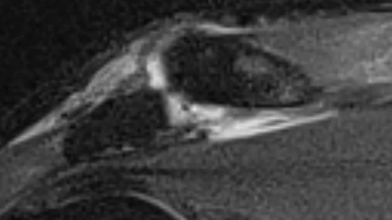 Acromioclavicular joint dislocation Grade 2-3 : X-ray and MRI finding ...