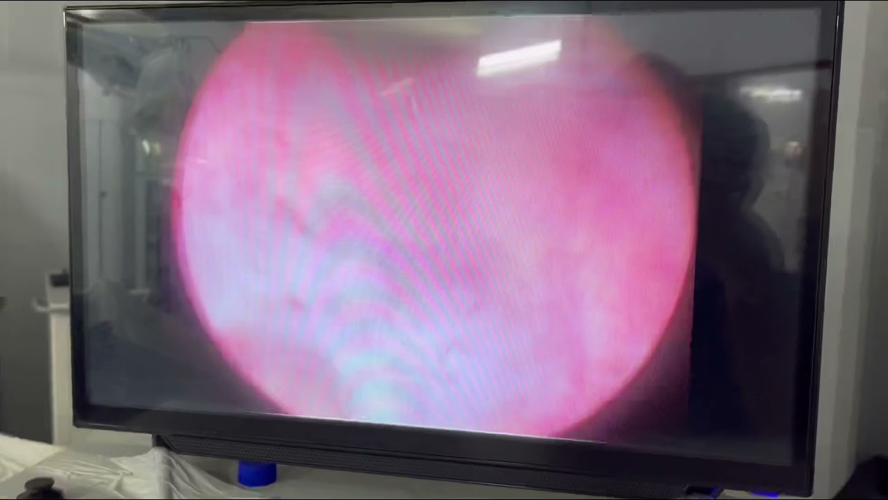 Check cystoscopy for bladder cancer patients - YouTube