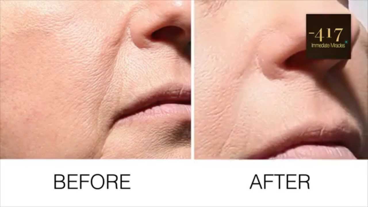 MIRACLE IMMEDIATE WRINKLE FILLER - YouTube