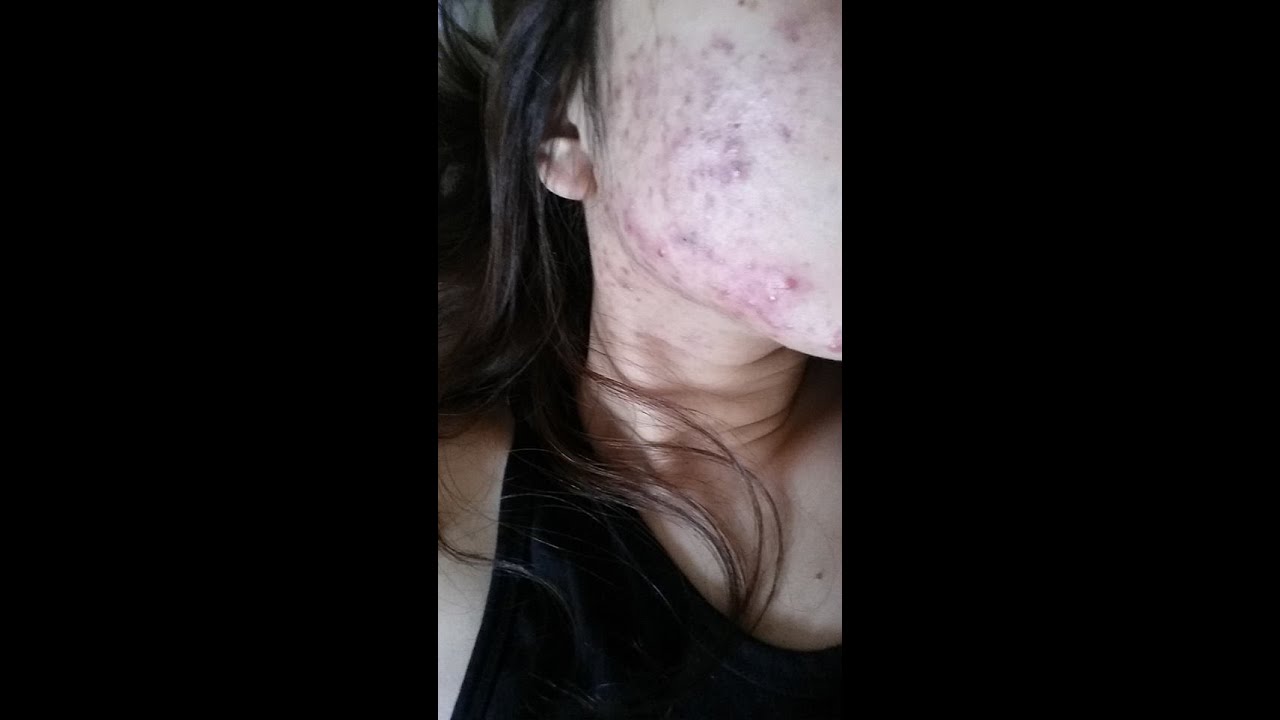 My Acne Journey Before Accutane Epuris Youtube