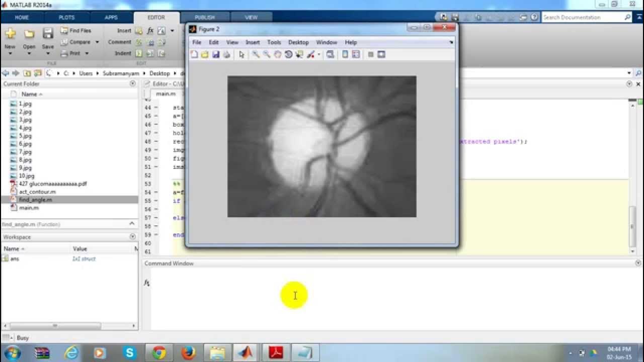 glaucoma detection using MATLAB - YouTube
