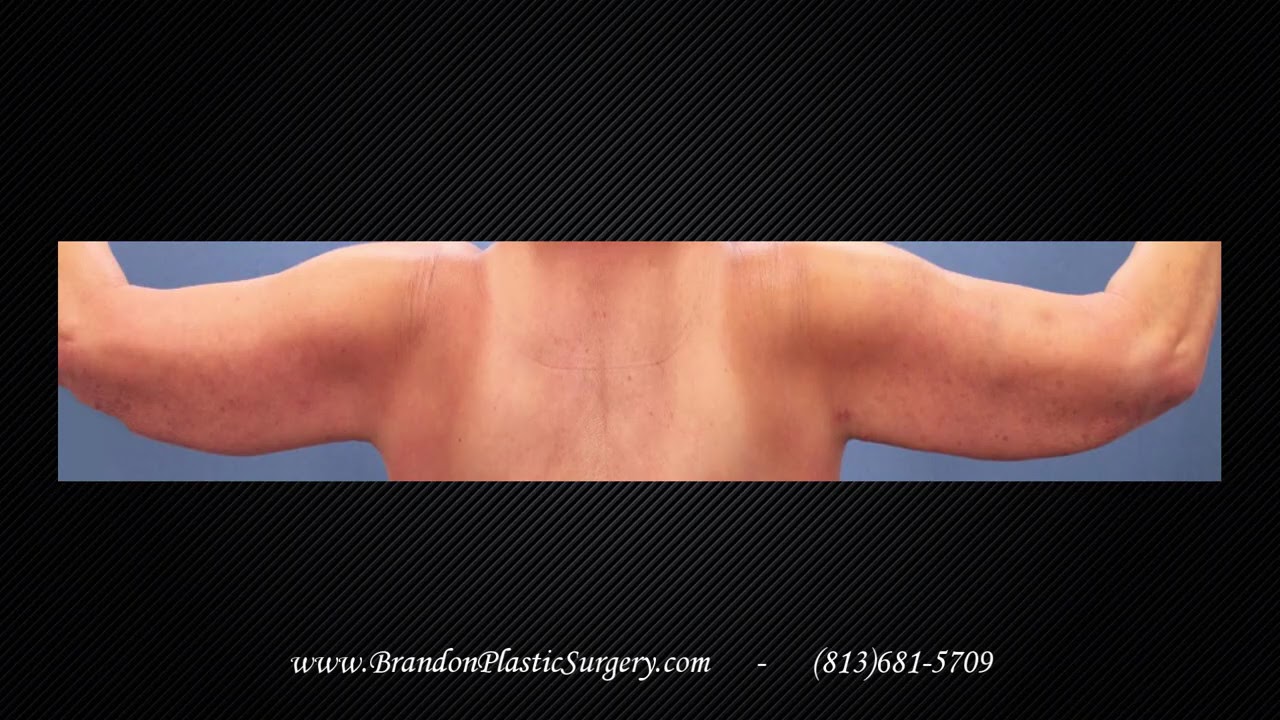 Scarless Arm Lift Before and After - YouTube
