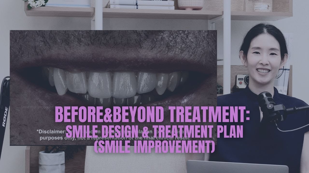 What Goes Into Smile Design And Treatment Planning? (SMILE IMPROVEMENT ...