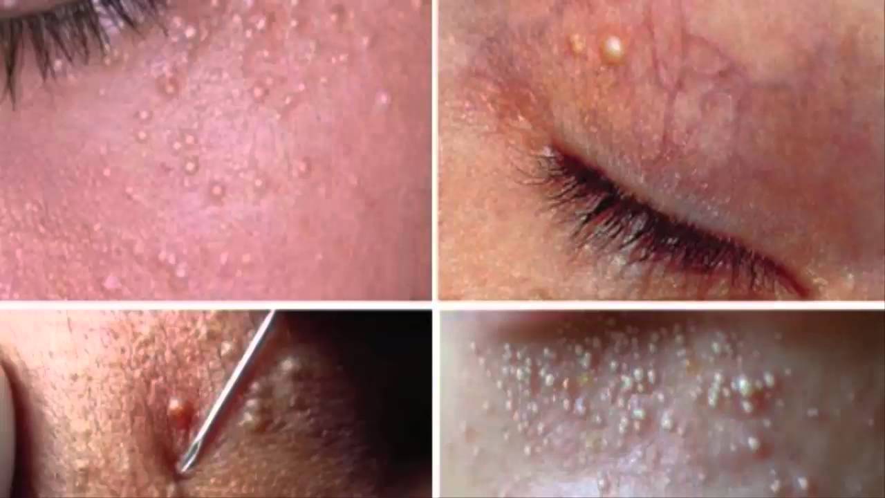 MILIA How To Remove The Small White Skin Cysts YouTube milia-how-to-remove-the-small-white-skin-cysts-youtube