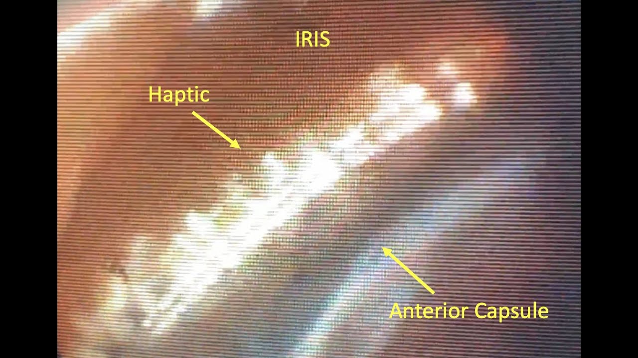 1 Slide in 5 Minutes: Uveitis-Glaucoma-Hyphema Syndrome (Malik Y ...