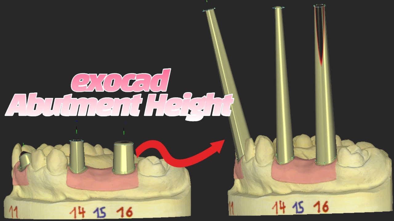 How To Change Height The Abutment In Exocad YouTube how-to-change-height-the-abutment-in-exocad-youtube