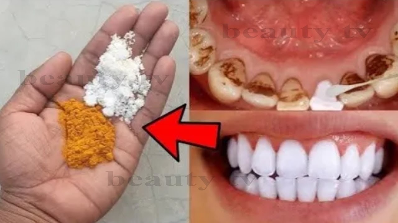 Magic Teeth Whitening - Remove Plaque and Tartar Fast! 🧙‍♂️ - YouTube