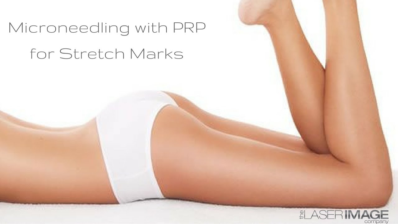 Microneedling With Prp For Stretch Marks Youtube