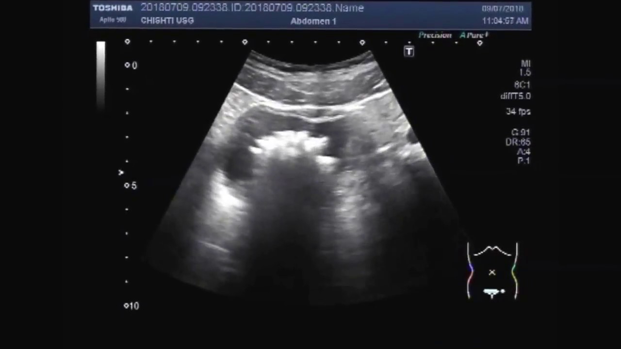 Ultrasound Video showing a large vesical stone with multiple small ...