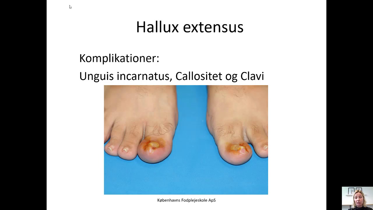 Hallux extensus - YouTube
