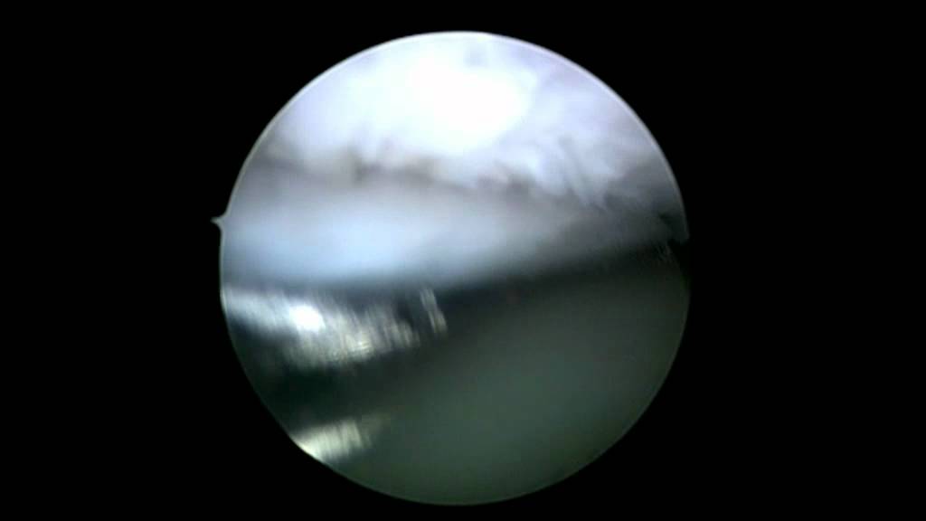 Left knee meniskus operation / Linkes Knie Meniskus Operation - YouTube
