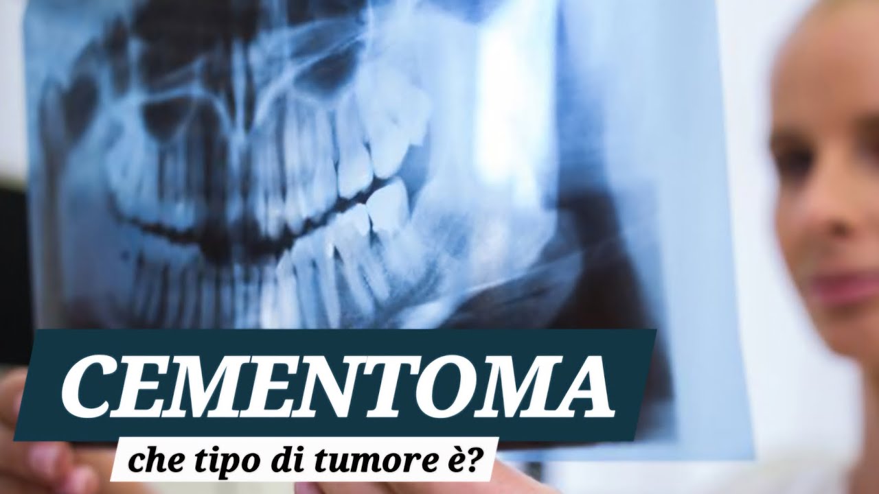 Cementoma: che tipo di tumore è? Cause, sintomi, diagnosi e cura - YouTube
