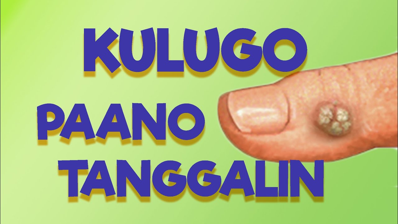 Pagtanggal Ng Kulugo Sa Paraan Na Hindi Masakit. - YouTube