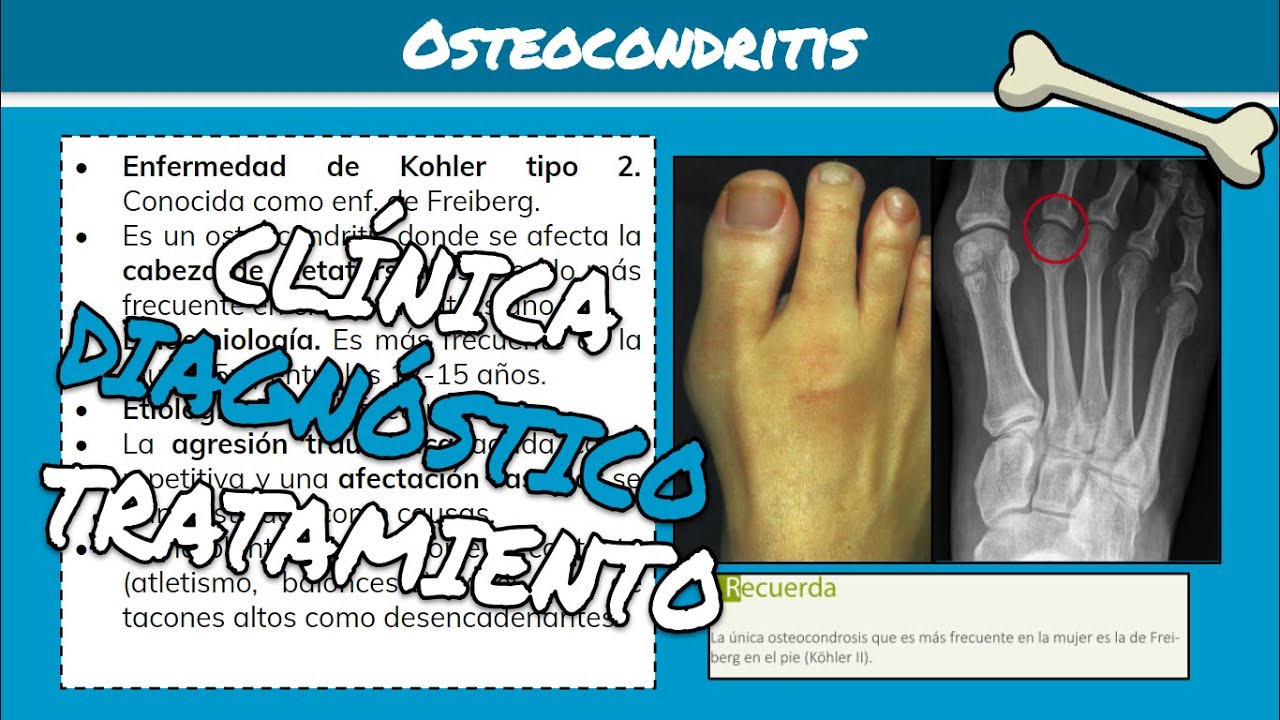 ⚕️🩺 Osteocondritis (ENFERMEDAD DE KOHLER TIPO 1 Y TIPO 2): Síntomas ...