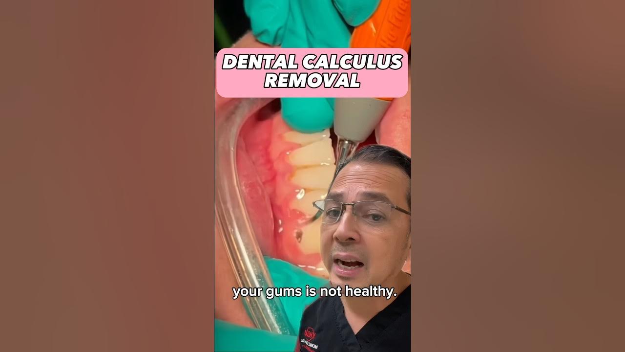 Removing Interproximal Calculus W Ultrasonic Scaler In Office To