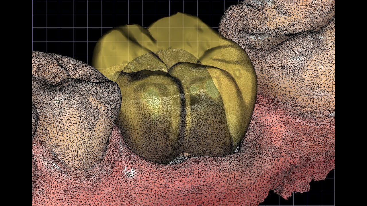 Vertiprep 3.6/build-up/crown removal - YouTube