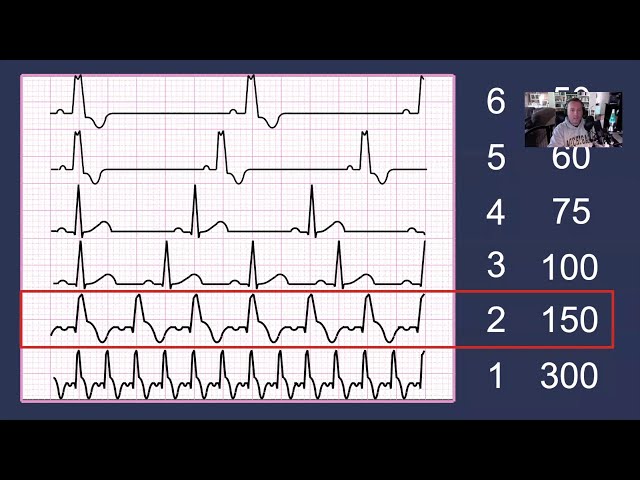 Ekg Heart Rate Scale How To Determine Heart Rate On ECG | Cerebro