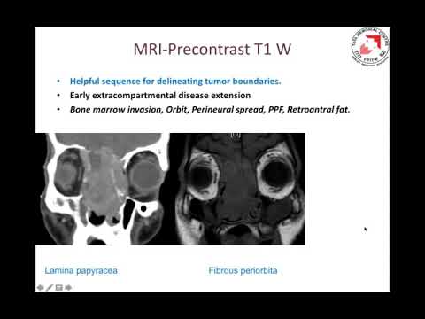 Imaging of PNS and anterior skull base tumors: Dr Amit Janu - YouTube