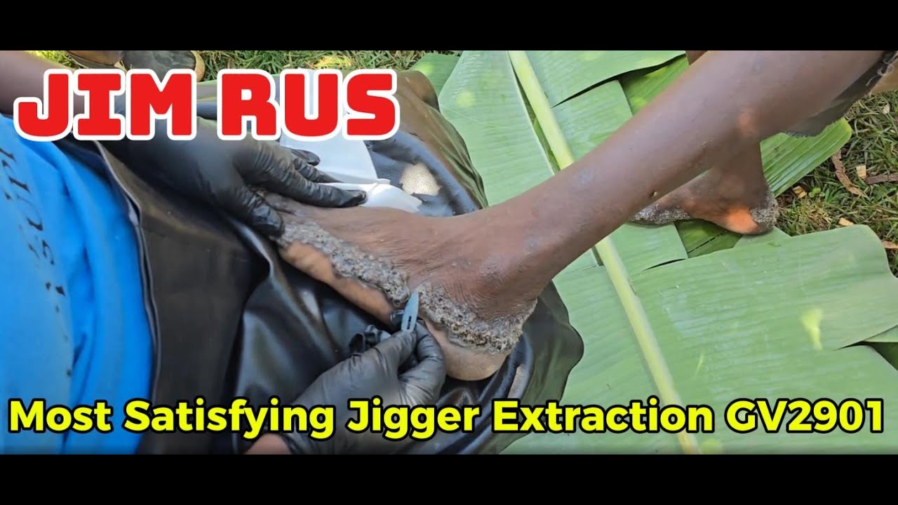 JIM RUS 🌀 Most Satisfying Jigger Extraction 💫 Deep Cleaning and Healing ...