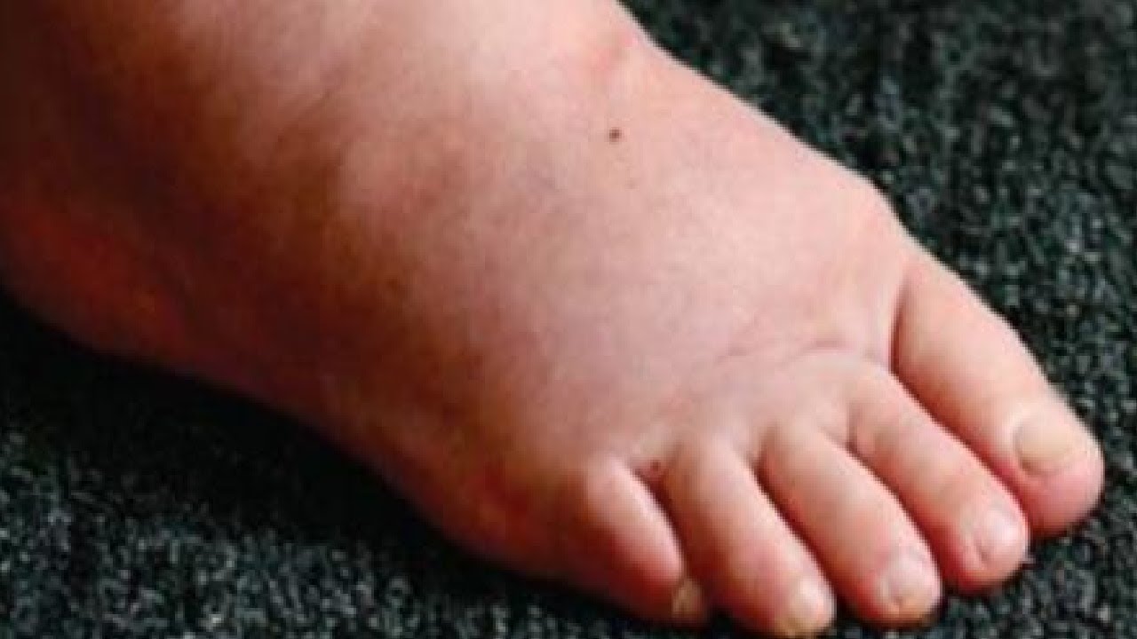 how to get rid of water retention in feet and ankles - YouTube