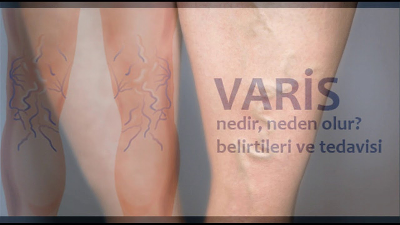 varis ve tedavisi - YouTube
