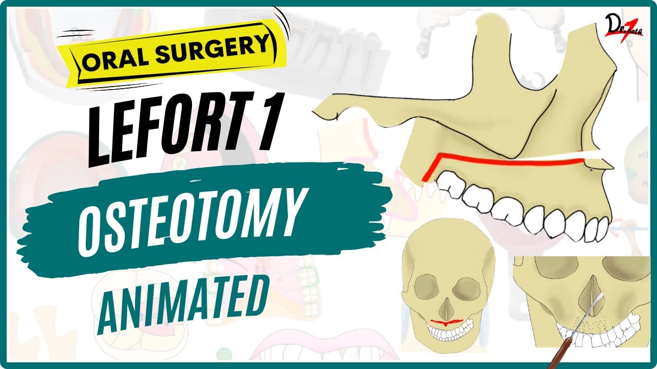 Lefort 1 Osteotomy - YouTube