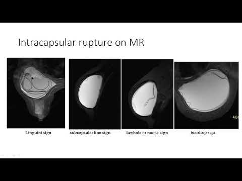 Diagnostic Workup in Breast Imaging - Implant Rupture on MR - YouTube