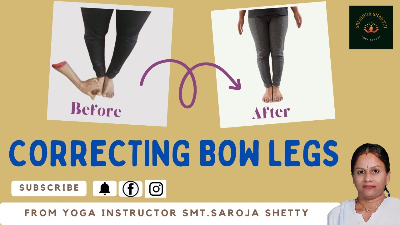 Correcting Bow legs - YouTube
