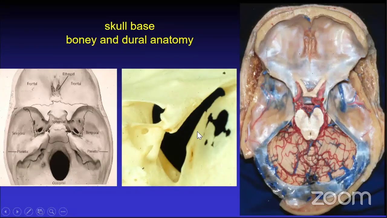 Anatomy and Surgery of Paraclinoidal Aneurysms- Art Day - YouTube