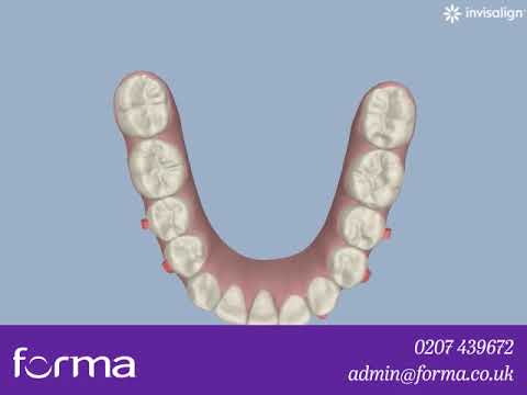 Forma Dental Invisalign Treatment time-lapse 08 - YouTube