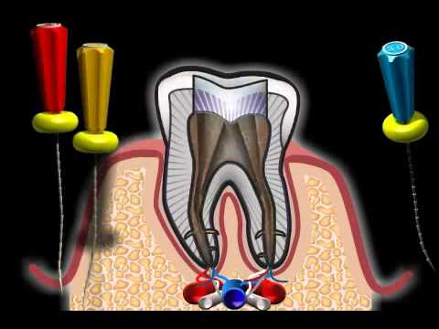 Paper Points for a perfect root canal treatment - YouTube