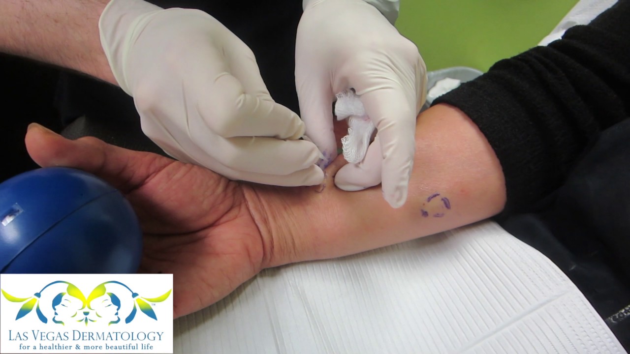 Sebaceous Cyst Removal at Las Vegas Dermatology - YouTube
