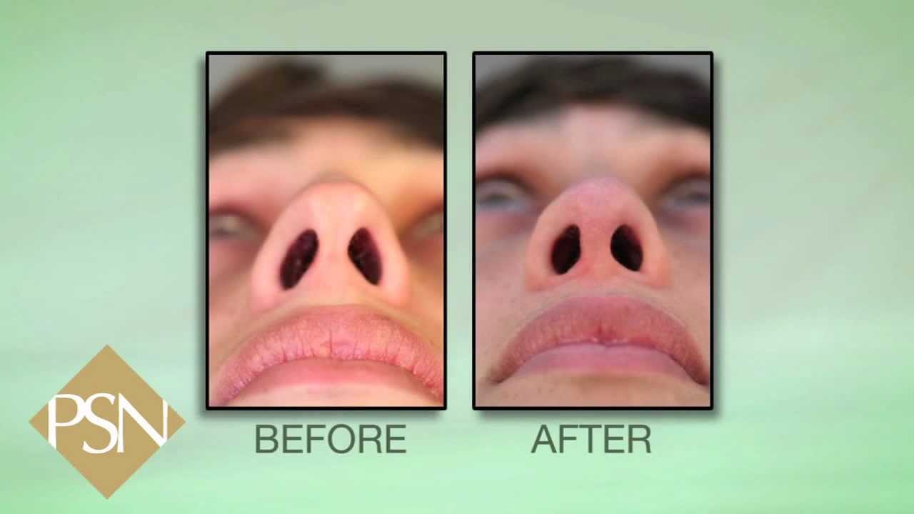 Rhinoplasty and Septoplasty - YouTube