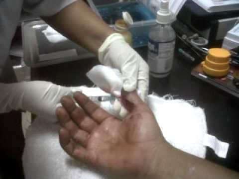 dedo cortado.3GP - YouTube