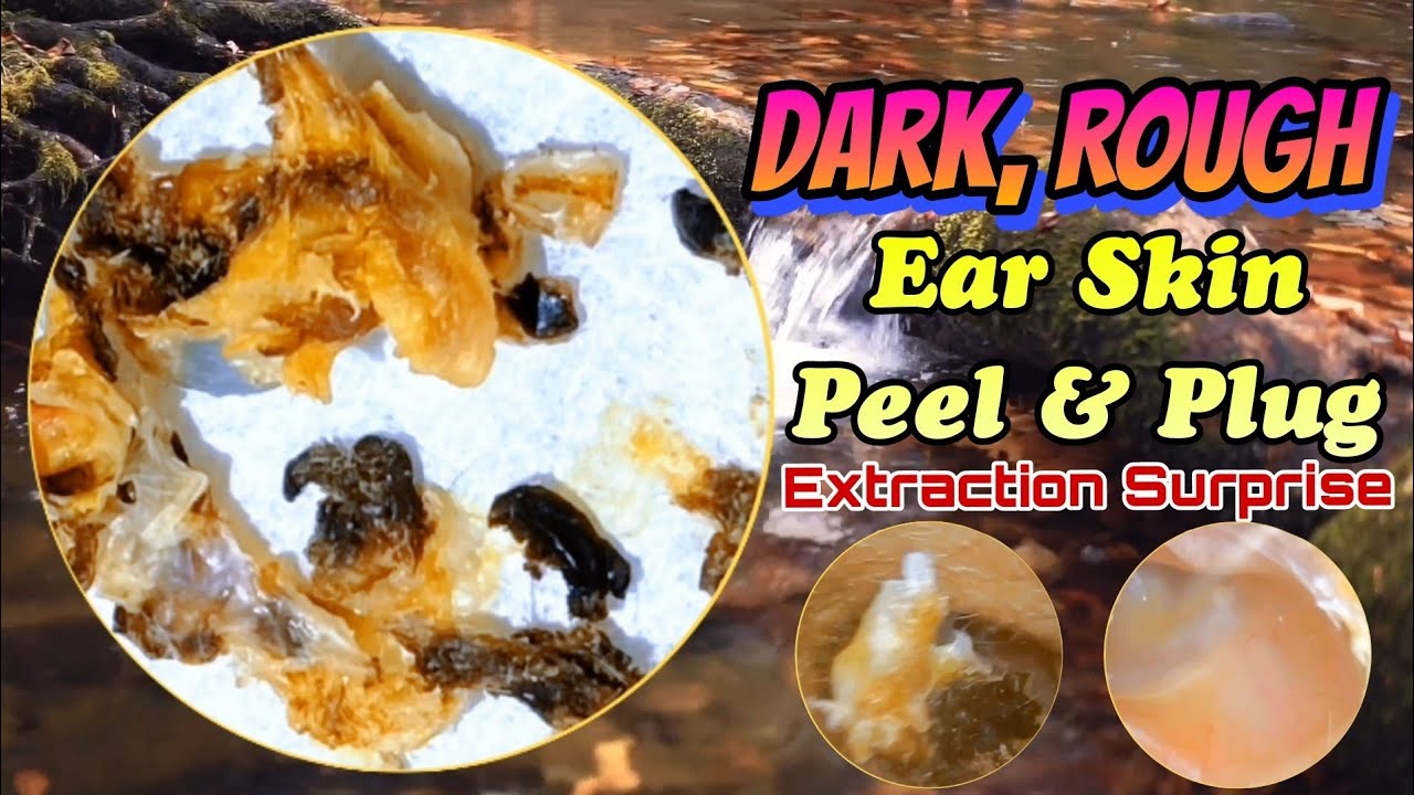 Dark, Rough Ear Skin Peel & Plug Extraction Surprise - YouTube