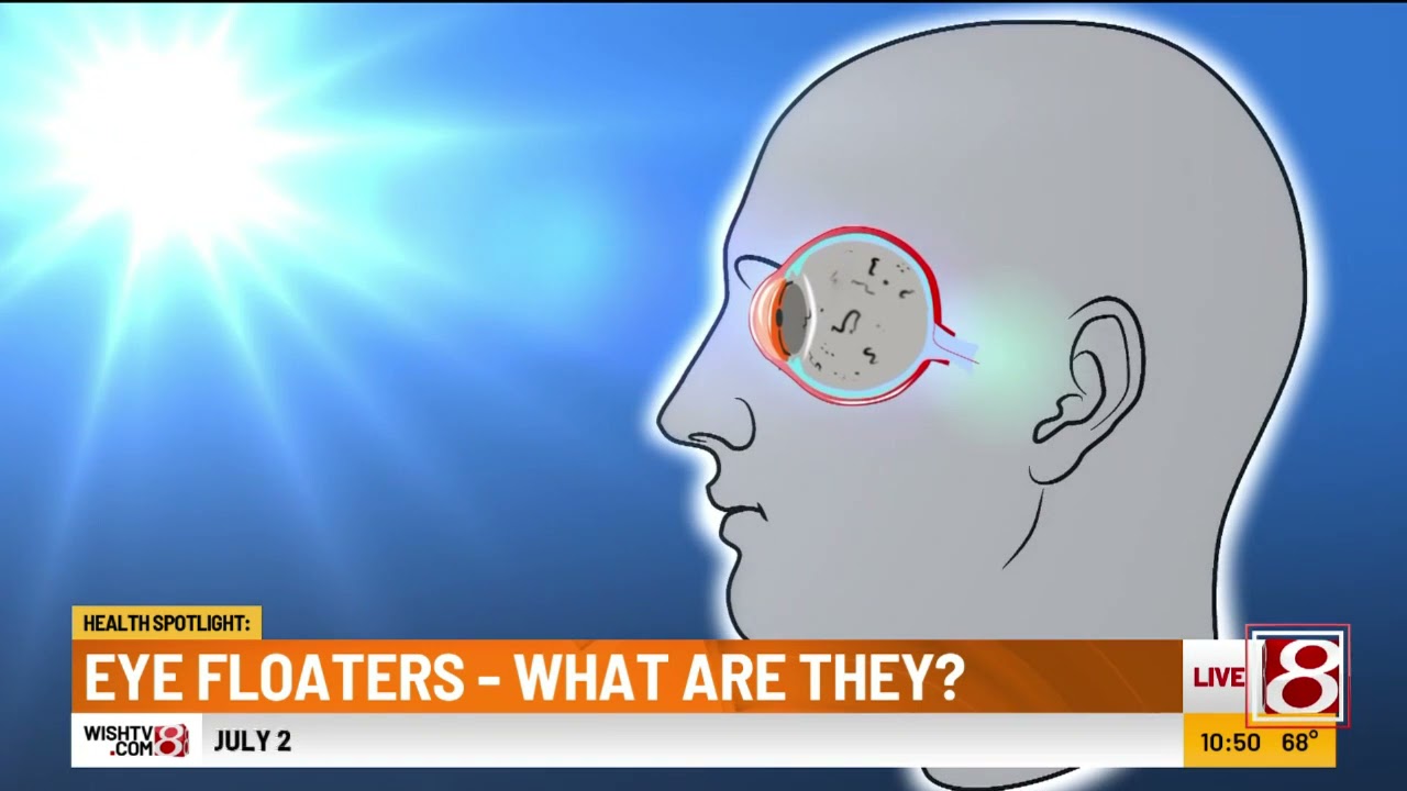 What Are Those Weird Dark Dots In My Vision And Why Do I Get Them What Are Those Weird Dark Dots In My Vision And Why Do I Get Them