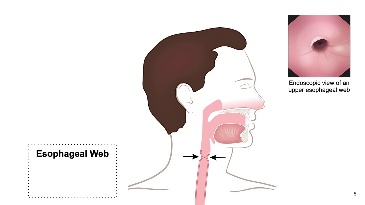 EGD-Colon-Entero-Lesson 2f3-Pathology of Esophagus-Web - YouTube